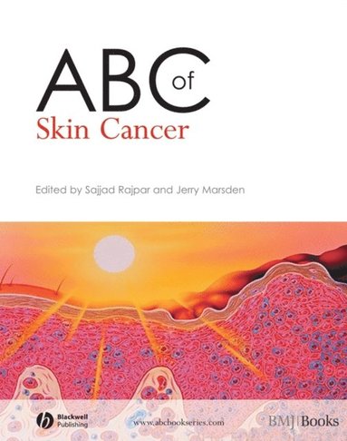 ABC of Skin Cancer - Ebok - Sajjad Rajpar, Jerry Marsden (9781444312508 ...