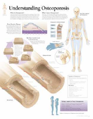 Understanding Osteoporosis Paper Poster - Scientific Publishing ...