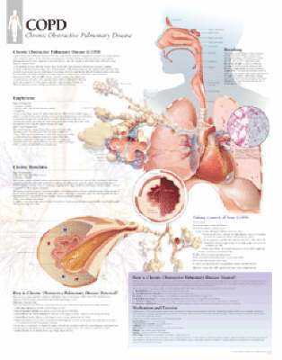 COPD (Chronic Obstructive Pulmonary Disease) Laminated Poster ...