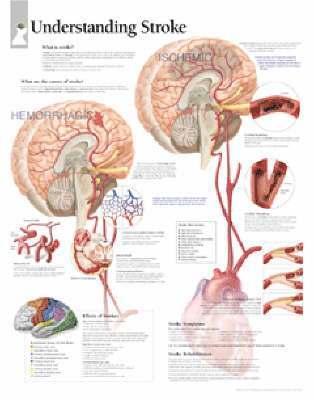 Understanding Stroke Laminated Poster - Scientific Publishing - Poster ...