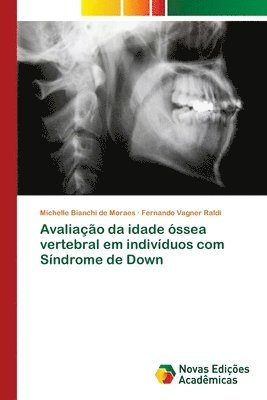 Avaliao da idade ssea vertebral em indivduos com Sndrome de Down - Michelle Bianchi De Moraes ...