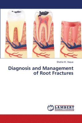 Diagnosis and Management of Root Fractures - Shehla W Haque - Häftad ...
