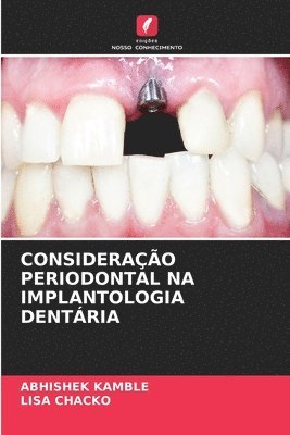 Considerao Periodontal Na Implantologia Dentria - Abhishek Kamble, Lisa ...