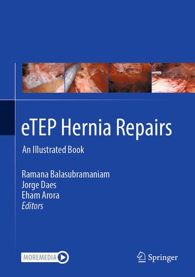eTEP Hernia Repairs - Ramana Balasubramaniam, Jorge Daes, Eham Arora ...