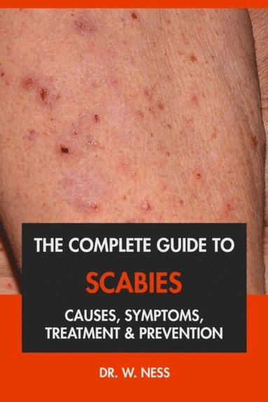 Complete Guide to Scabies: Causes, Symptoms, Treatment & Prevention ...