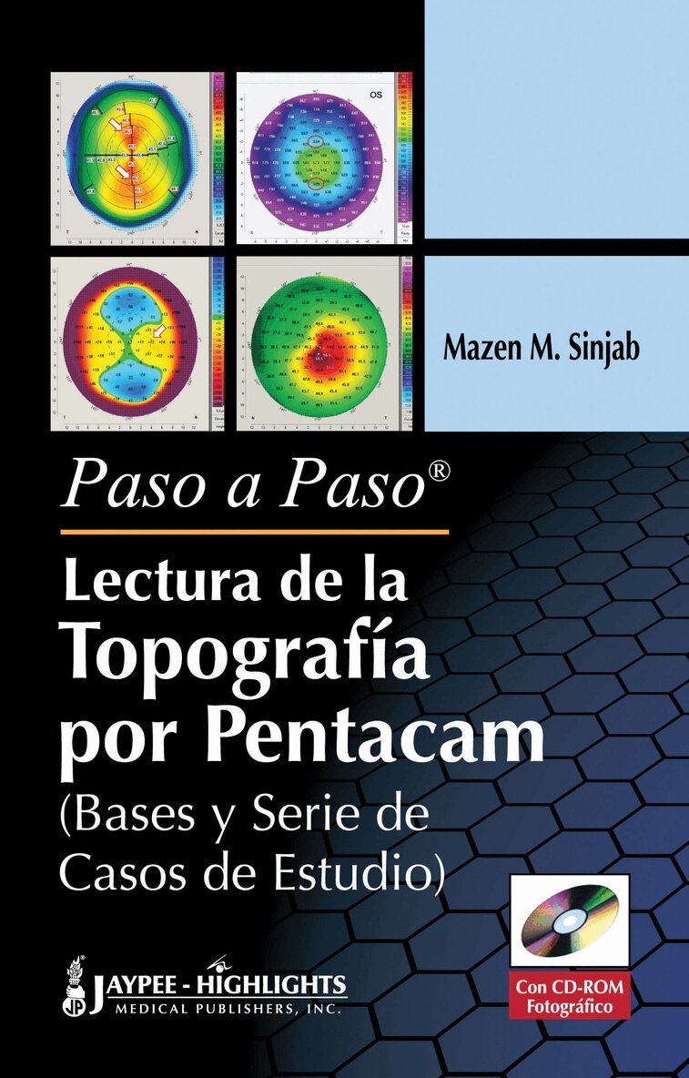 Paso a Paso - Lectura de la Topografía por Pentacam - Mazen M Sinjab ...